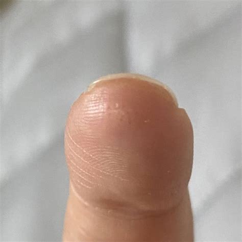 ㅎㅇㅈㅇ손가락 끝에 이상한거 났는데 인스티즈instiz 일상 카테고리