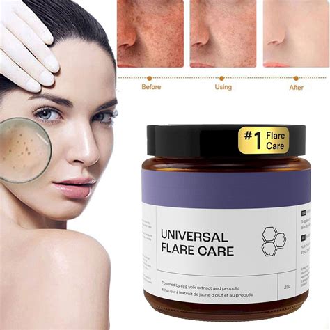 Universal Acne Care Relieves 97 Of Skin Issues All Natural Acne