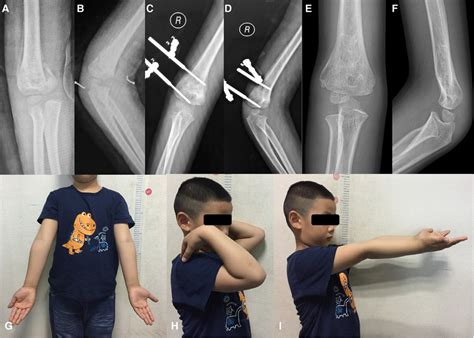 Frontiers Small Incision Reduction And External Fixation For The