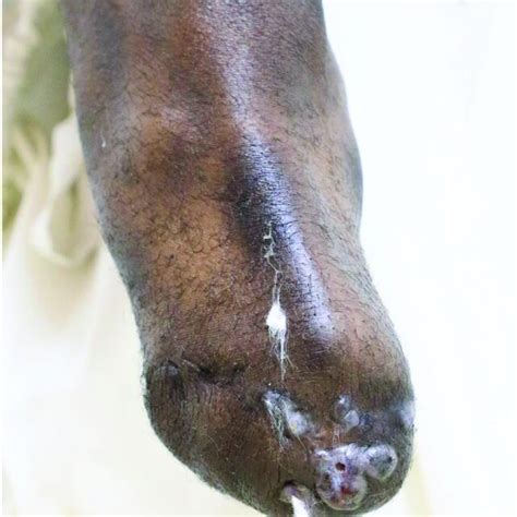 Photograph Showing Recurrence At The Right Below Knee Stump