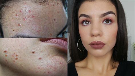 Acne Coverage Makeup Tutorial And Foundation Routine 2018 Youtube