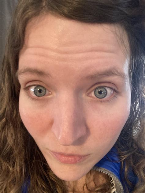 I Got Botox On March 7th And Its Almost All Worn Off Has Anyone Else Had This Happen R