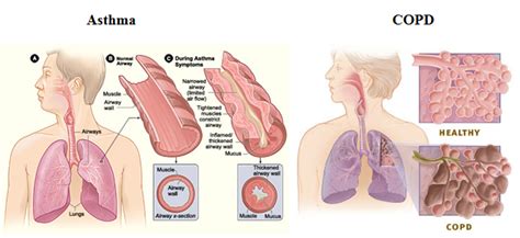 Know The Difference Asthma And COPD Health Products For You