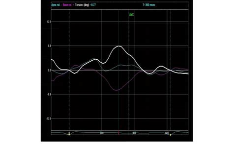 Lv Torsion In A Patient From Lv Remodeling Group 877 Degree