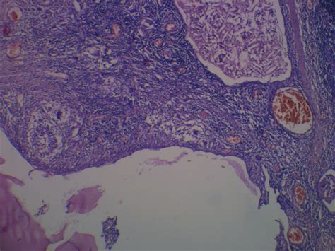 Pathology Outlines Thymic Cyst