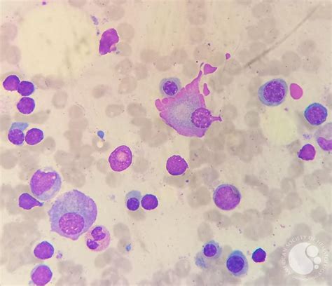 Flame Cell Plasma Cell Myeloma