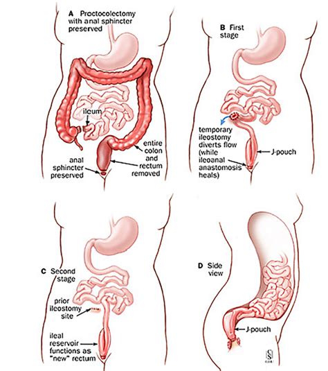 Total Proctocolectomy With J Pouch