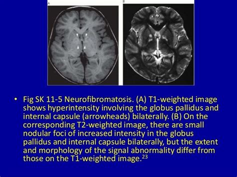 11 Hyperintense Basal Ganglia On T1 Weighted Magnetic Resonance