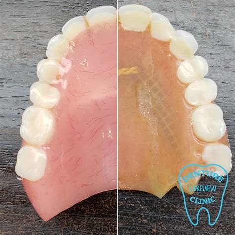 What Is Reline And Rebase Dentures At Will Pedroza Blog