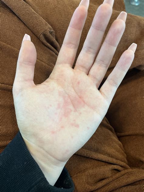 Mild Chronic Urticaria More Info In Comments Rurticaria