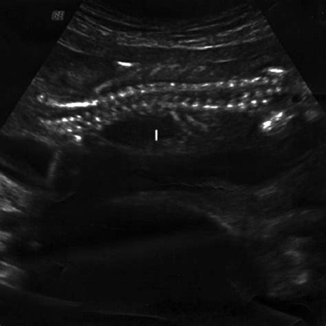 Ectopia Cordis Midline Supraumblical Defect Of Thoracoabdominal Wall Download Scientific