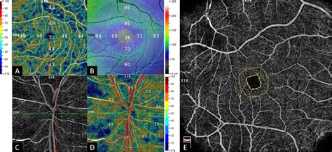 Octa Images A Superficial Vessel Dinsity B Inner Thickness C Radial