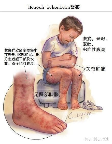 过敏性紫癜患者一般做哪些检查？ 知乎