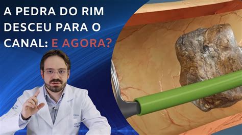 Pedra No Rim Ou No Canal Qual A Diferença Youtube