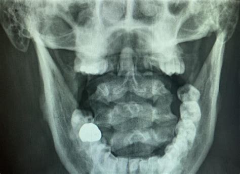 3 Vertebrae Odontoid For Your Viewing Pleasure I Did Not Take This