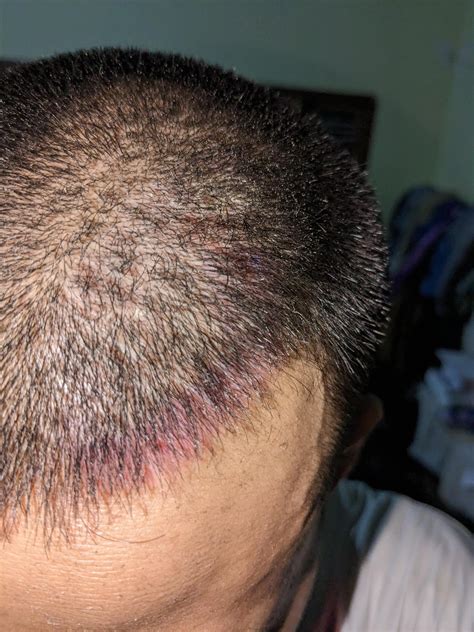 Psoriasis Or Seborrheic Dermatitis Rpsoriasis