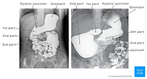 Duplication Of Duodenum Clinical Case And Cadaver Images Kenhub