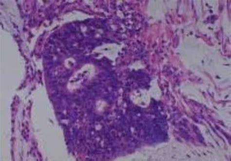 Novus Biologicals Human Colon Tissue Microarray Rectal Cancer Human