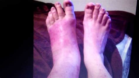 Cellulitis Big Toe Infection