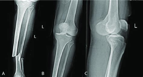 Initial Radiographs Showing The Dislocated Knee With Simultaneous