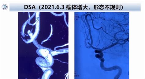 一周精选，这些神介手术视频值得再学习一遍（9 1 9 8） 脑医汇