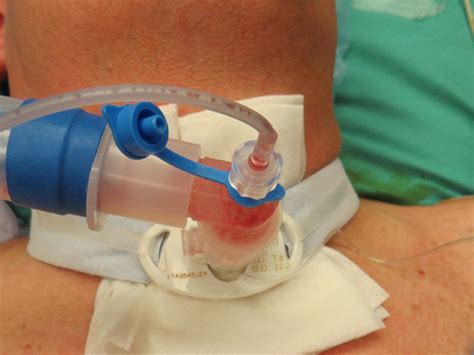 Cricothyrotomy For Elective Difficult Airway Management Iowa Head And Neck Protocols