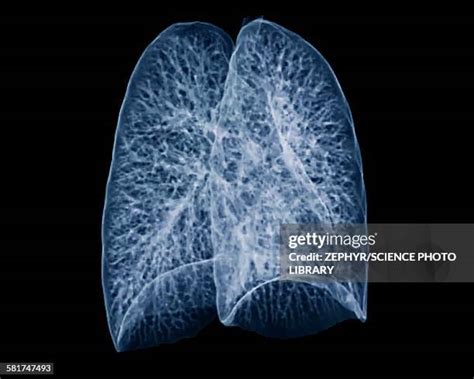 Lung Cat Scan Photos And Premium High Res Pictures Getty Images