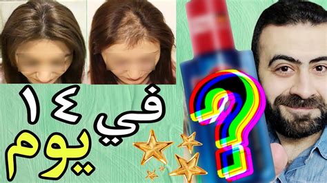 انبات الشعر بسرعه في اسبوعين و اطالة الشعر و تكثيفه و ملئ فراغات