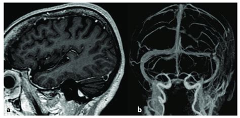 A Contrast Enhanced T1 Image Sagittal Plane Filling Defect In The Download Scientific