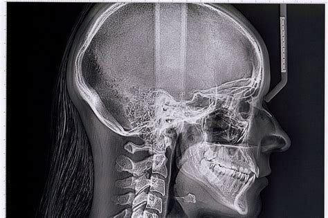 Сephalometry Ceph Tooth Dental Xray Malocclusion X Ray Xray Art Teeth