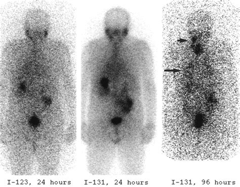 Comparison Of 123i And 131i For Whole Body Imaging In Thyroid Cancer