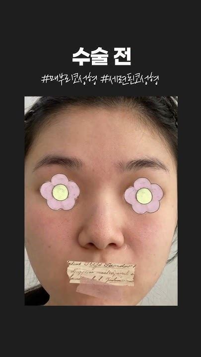 매부리코성형 매부리 살짝 깎고 티나지 않게 예뻐진 후기 Youtube