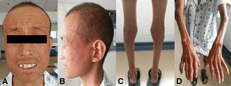The Appearance Of The Patient And His Form Extremely Slight A