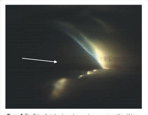 Figure 1 From Angle Closure Glaucoma Pathogenesis And Evaluation A Review Semantic Scholar