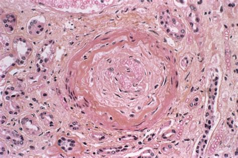 Crest Scleroderma Scalp