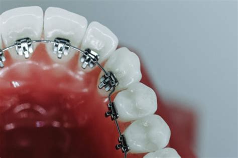 Lingual Braces Bristol Dental Practice