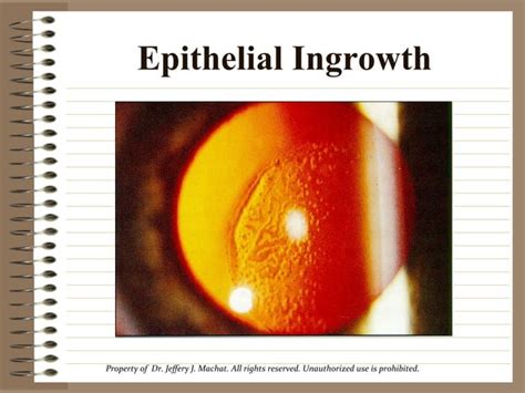 Lasik Complications 2001 Epithelial Ingrowth By Dr Jeffery Machat Pdf