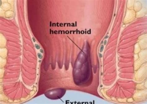 Salep Wasir Inilah Jambi