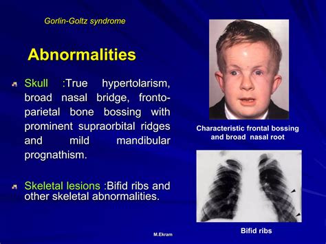 Common Syndromes Affecting The Head And Neck Ppt