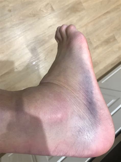 Chronic Ankle Instability KH Physiotherapy KH Physiotherapy