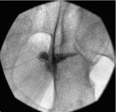 Pudendal Block With Needle Visualized Advancing To The Base Of Ischial