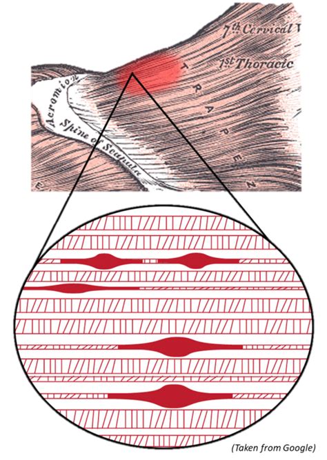 What Is A Myofascial Trigger Point