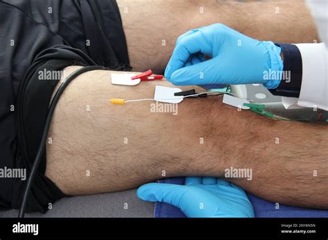 Electromyography Emg And Somatosensory Evoked Potential Pev Of Lower