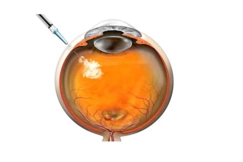 How Much Does Private Macular Degeneration Treatment Cost