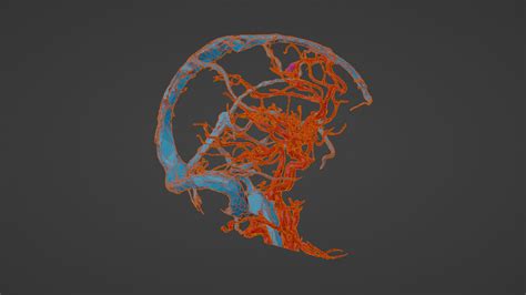 3d Model Of Brain Arteriovenous Malformation By Azekapeka