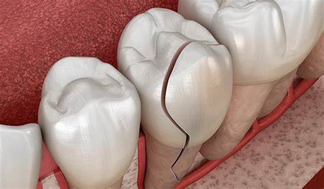What Is Teeth Chipping Causes Recovery And Its Treatment Options
