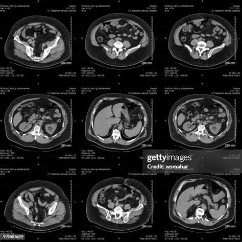Normal Ct Scan Abdomen