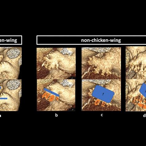 Laa Classification With Chicken Wing A And Non Chicken Wing