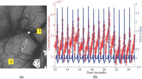 Laser Speckle Contrast Imaging Of Cerebral Blood Flow In Humans During