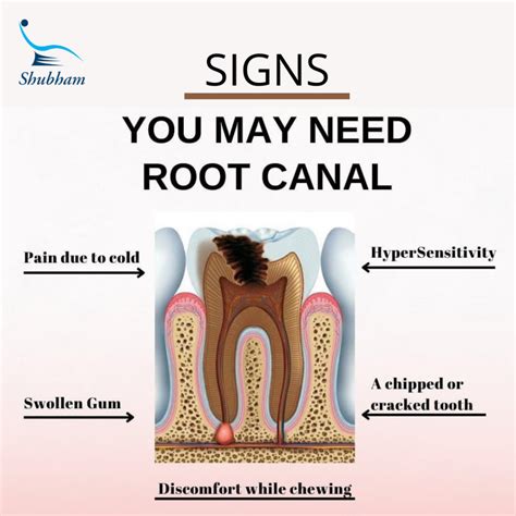 Warning Signs That You Need Root Canal Treatment Shubham Dental Clinic